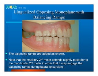 19. occlusal schemes lingualizied oposing monoplane with balancing ...