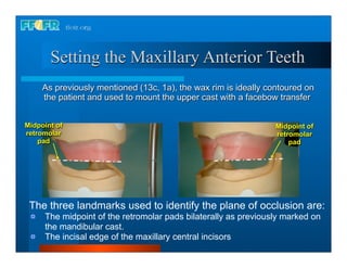 19. occlusal schemes lingualizied oposing monoplane with balancing ...