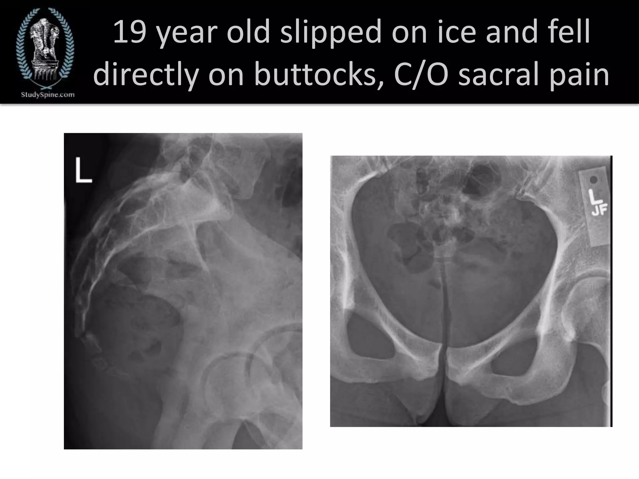 19 year old fell on buttocks and complains of sacral pain | PPT