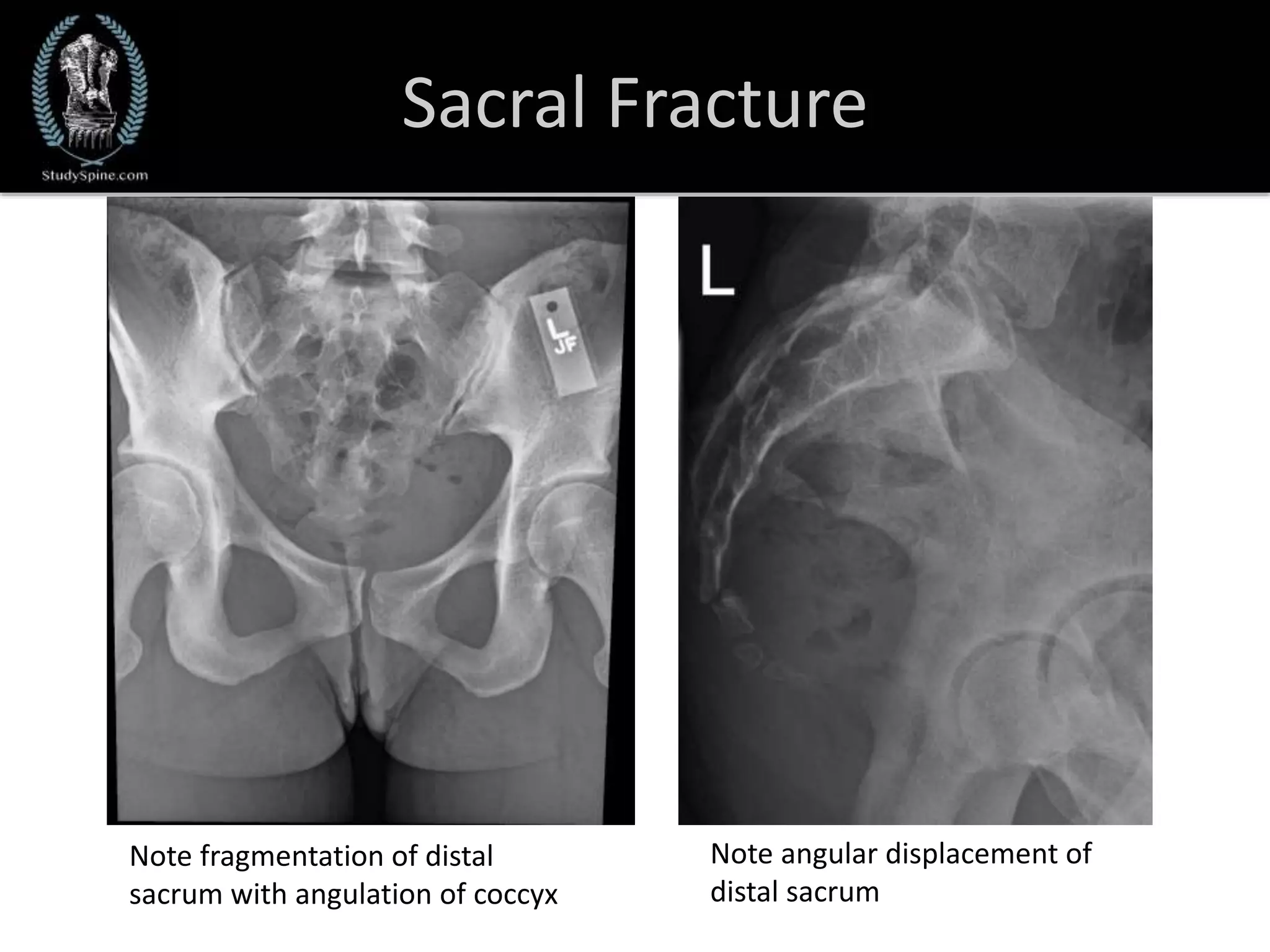 19 year old fell on buttocks and complains of sacral pain | PPT