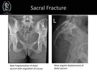 19 year old fell on buttocks and complains of sacral pain | PPT