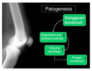 Osteoarthritis Refrat | PDF