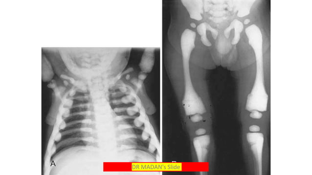191019 osteopetrosis | PPTX