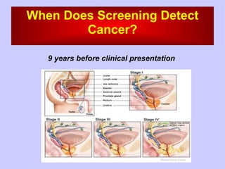 Prostate cancer (screening) | PPT