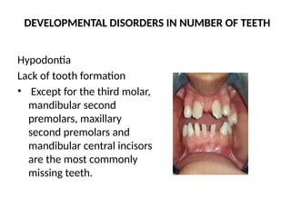 199.CONGENITAL ANOMALIES OF TEETH an INTRO.pptx