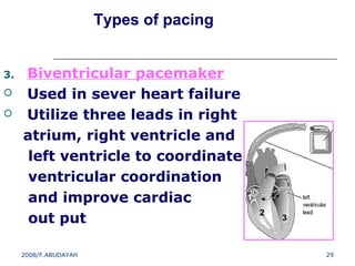Biventricular Pacemaker