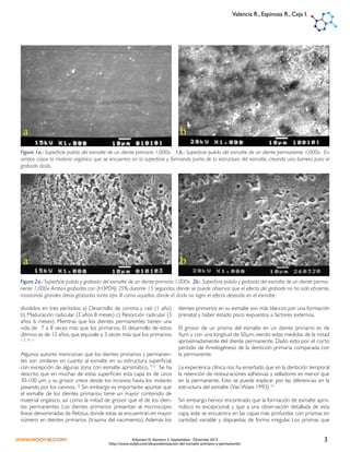 19 articulo desproteinización del esmalte primario y permanente | PDF