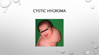 Cystic Disorders of Neck | PPTX