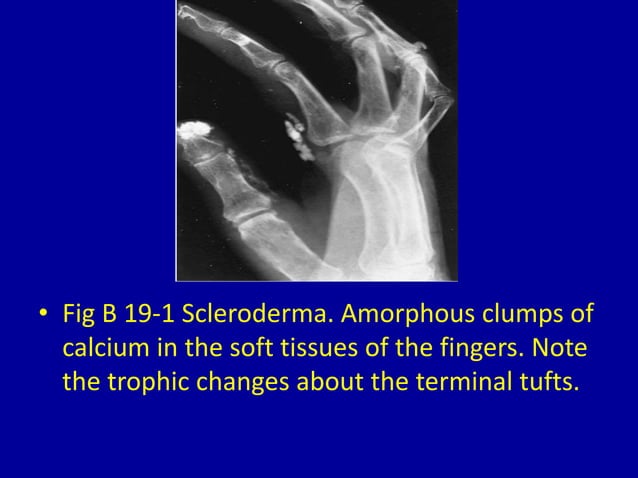 19 calcification about the fingertips | PPT