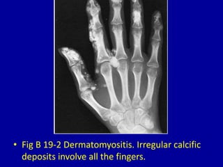 19 calcification about the fingertips | PPTX