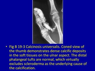 19 calcification about the fingertips | PPT