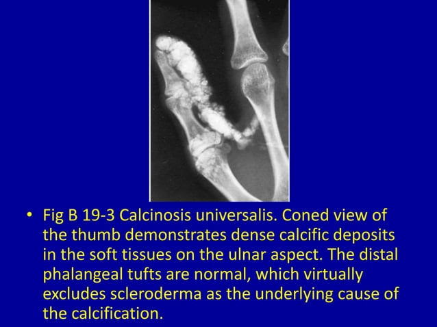 19 calcification about the fingertips | PPT | Free Download
