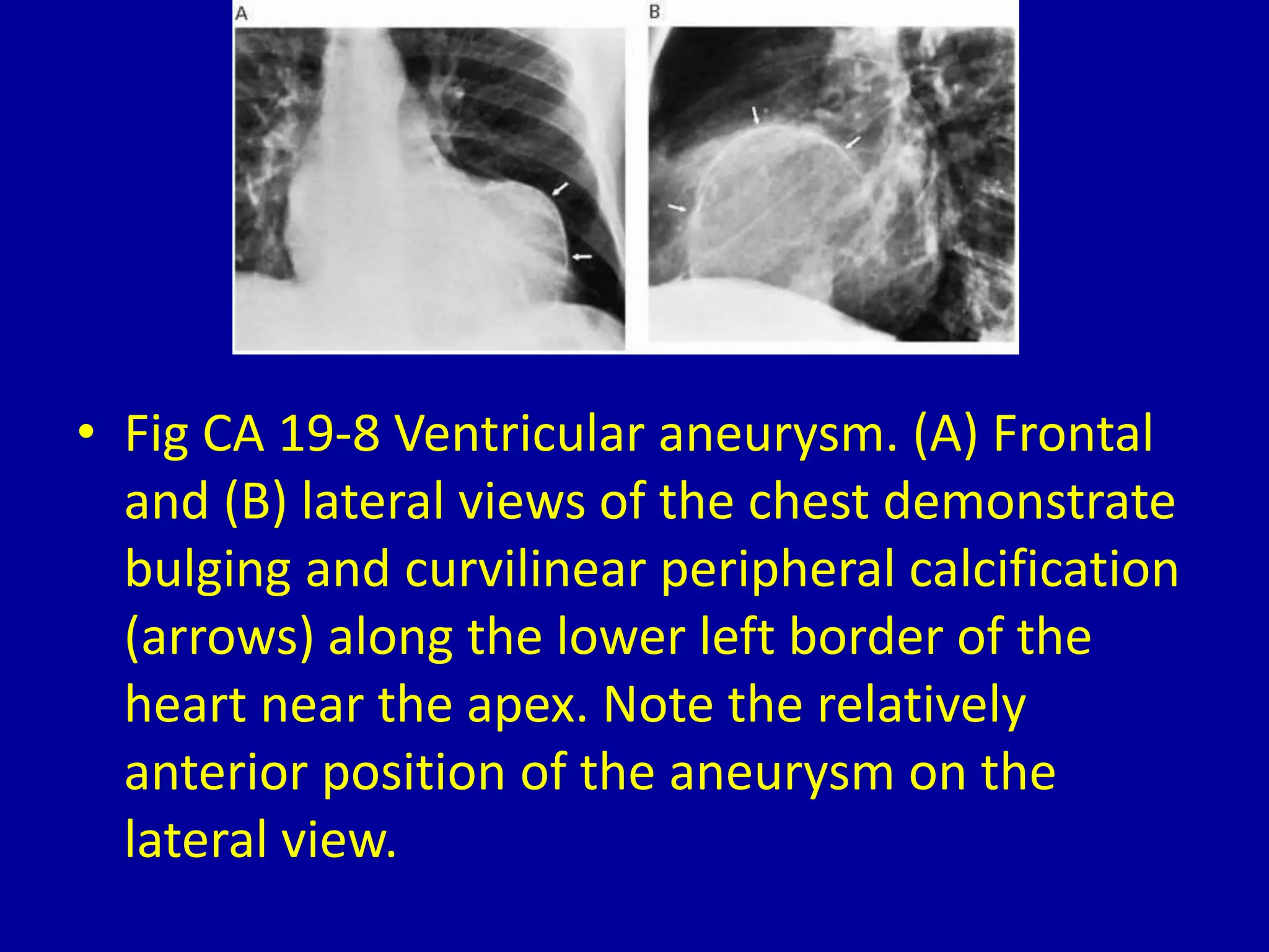 19 cardiovascular calcification | PPTX