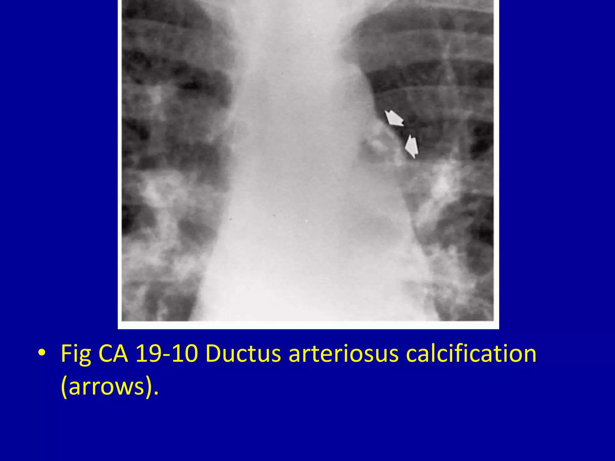 19 cardiovascular calcification | PPTX