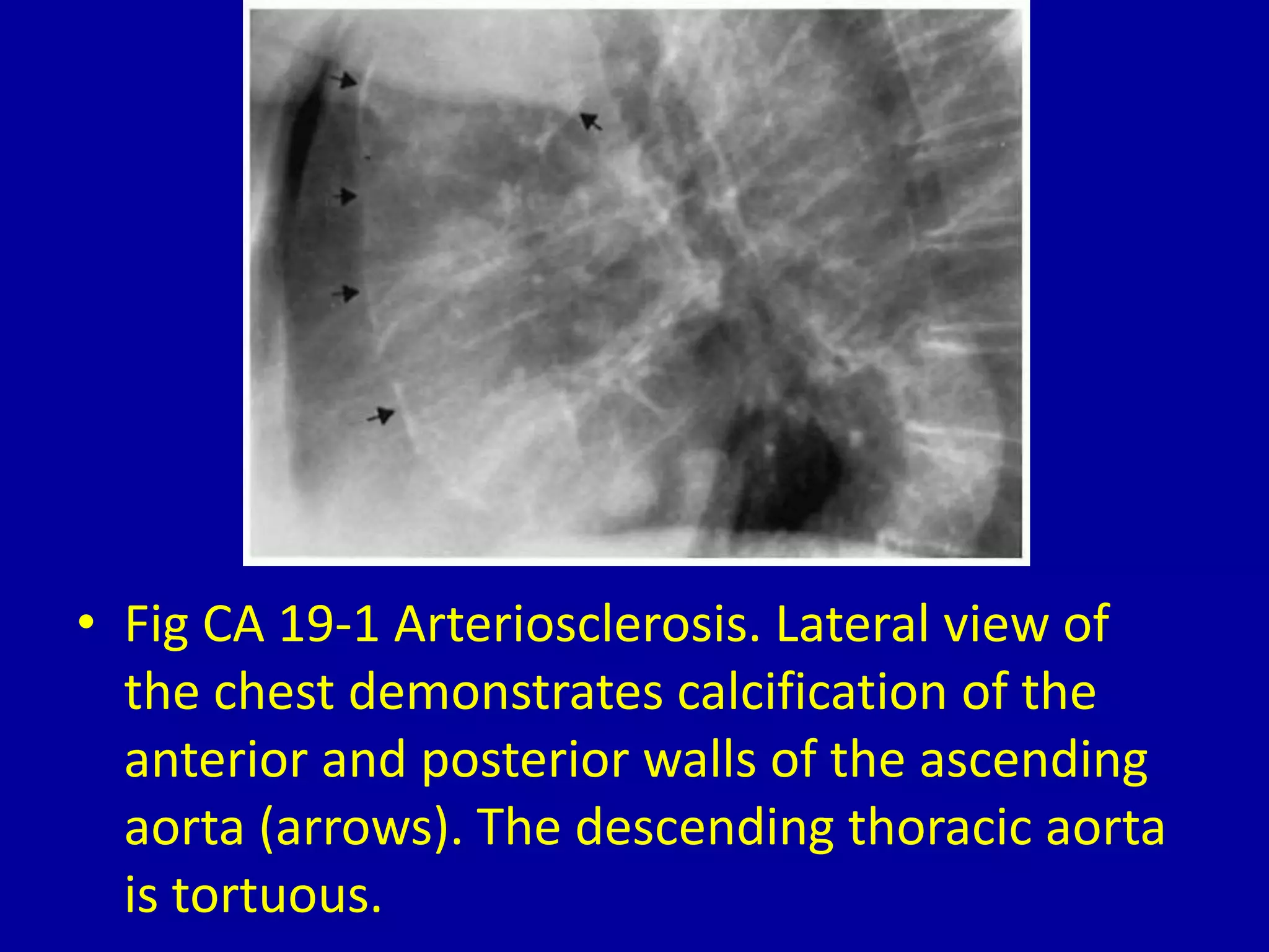 19 cardiovascular calcification | PPTX
