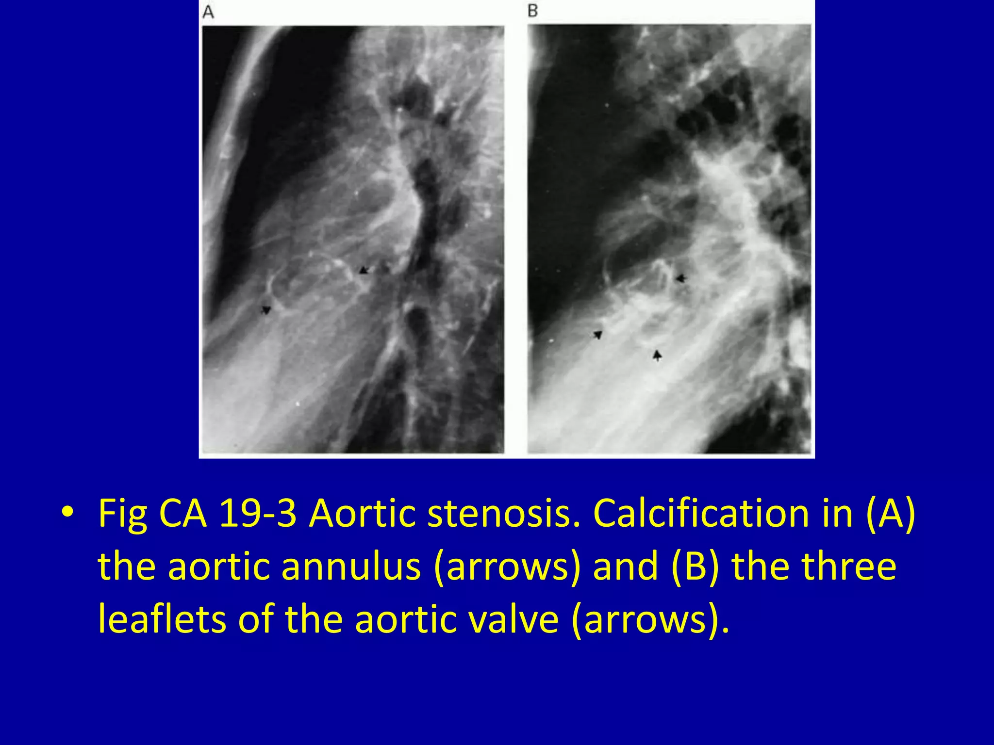 19 cardiovascular calcification | PPTX