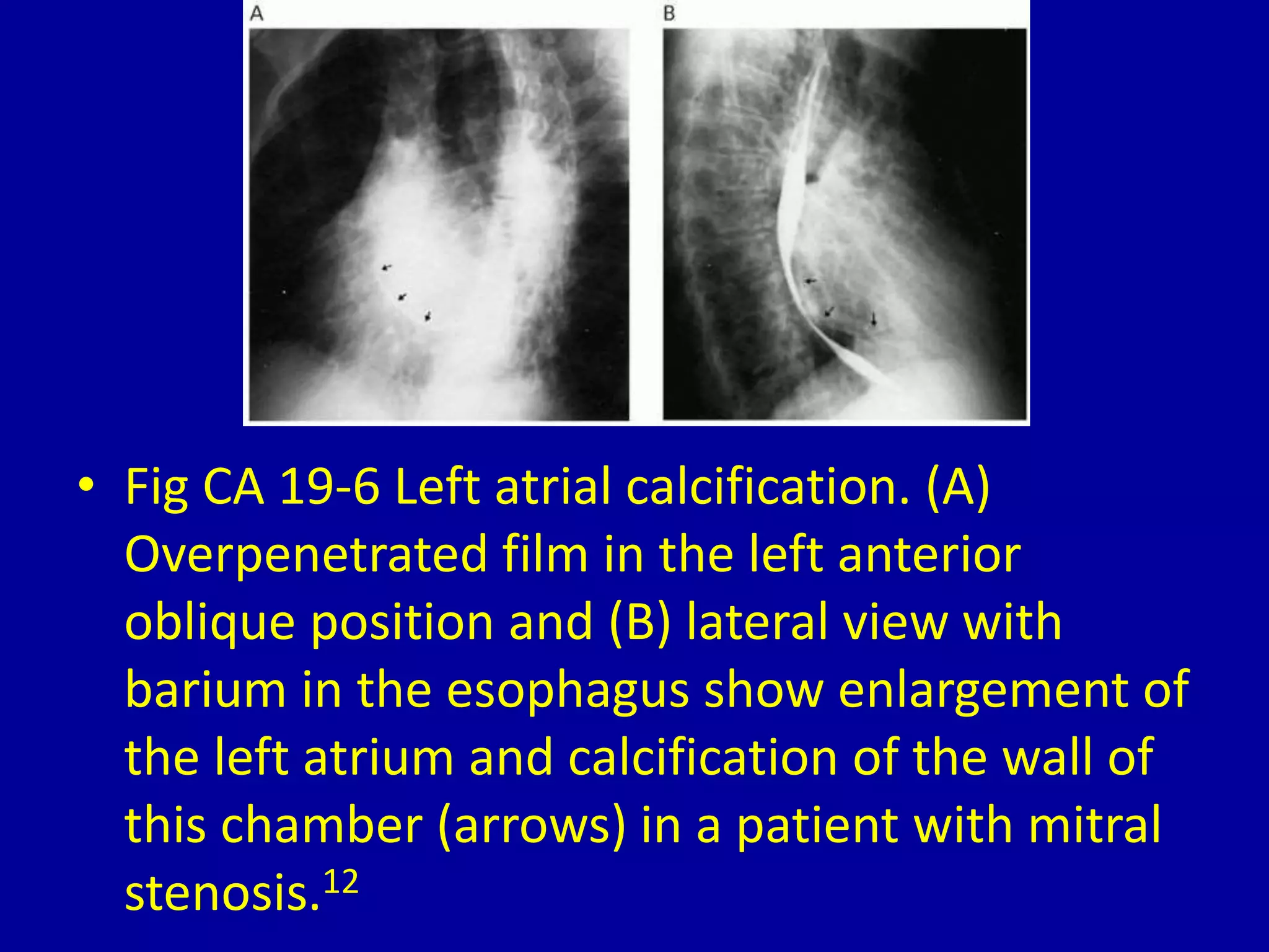 19 cardiovascular calcification | PPTX