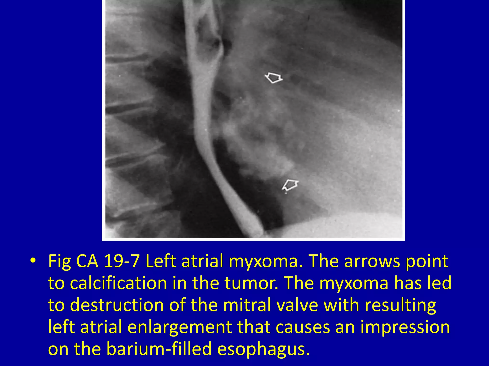 19 cardiovascular calcification | PPTX