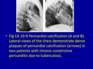 19 cardiovascular calcification | PPTX