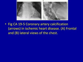 19 cardiovascular calcification | PPTX