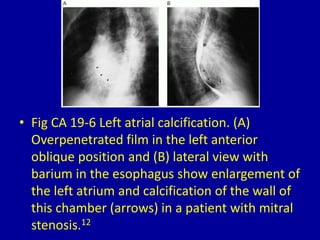 19 cardiovascular calcification | PPTX