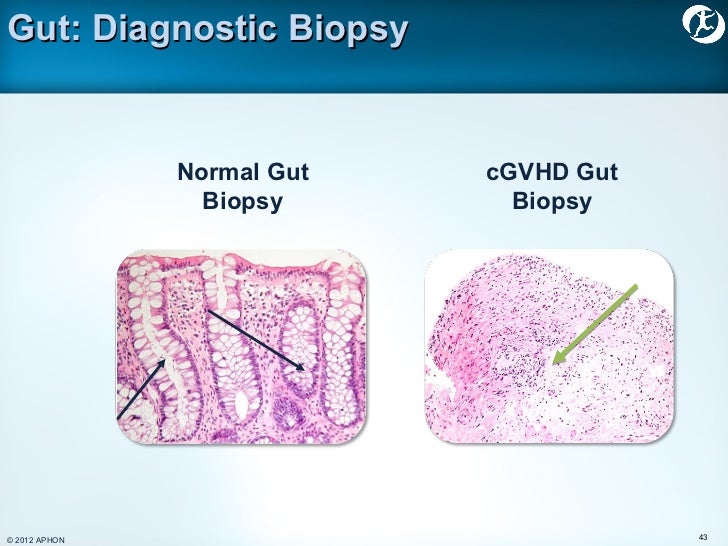 19 chronic%20 gvhd[1]