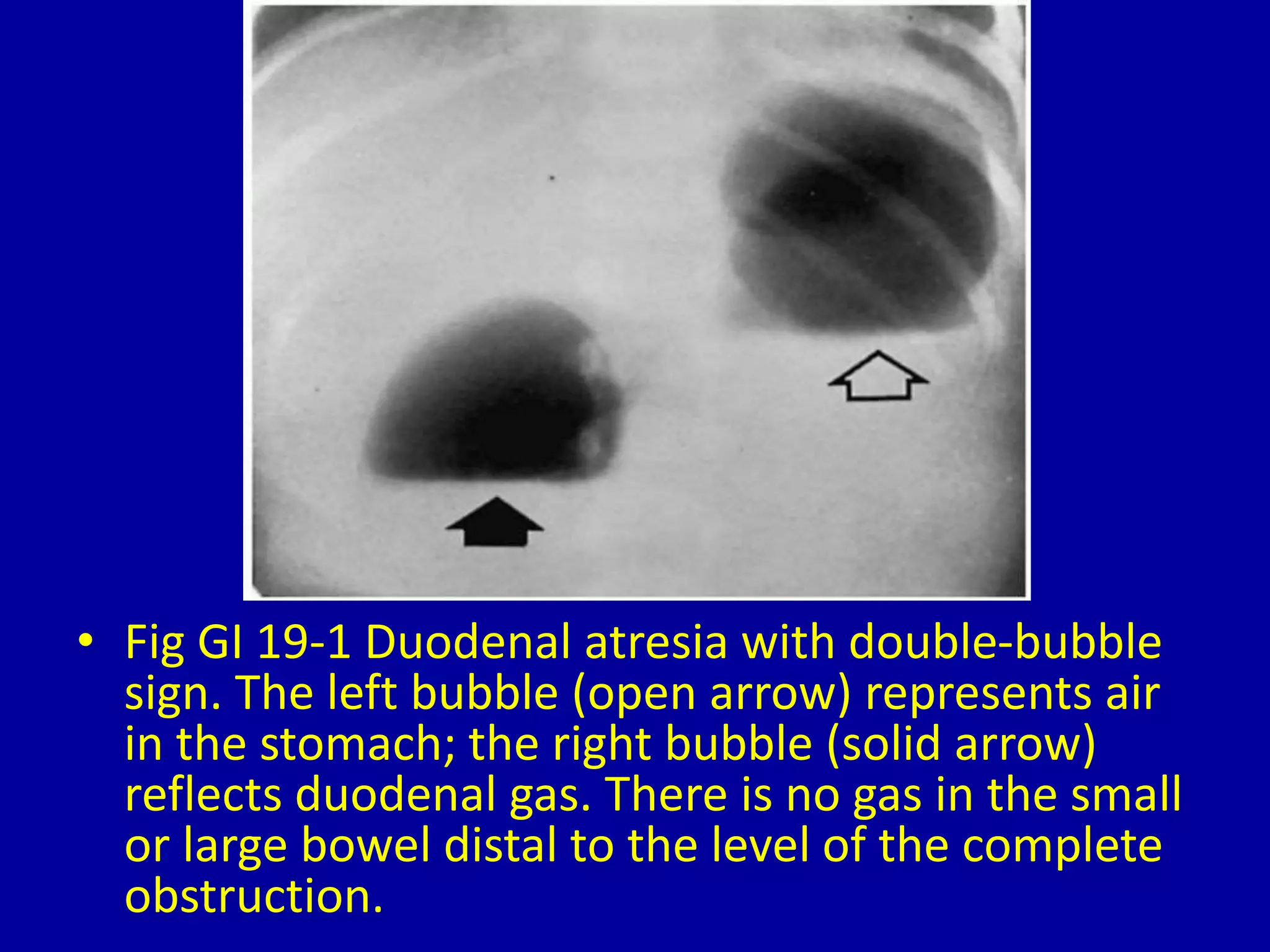 19 duodenal narrowing or obstruction | PPTX