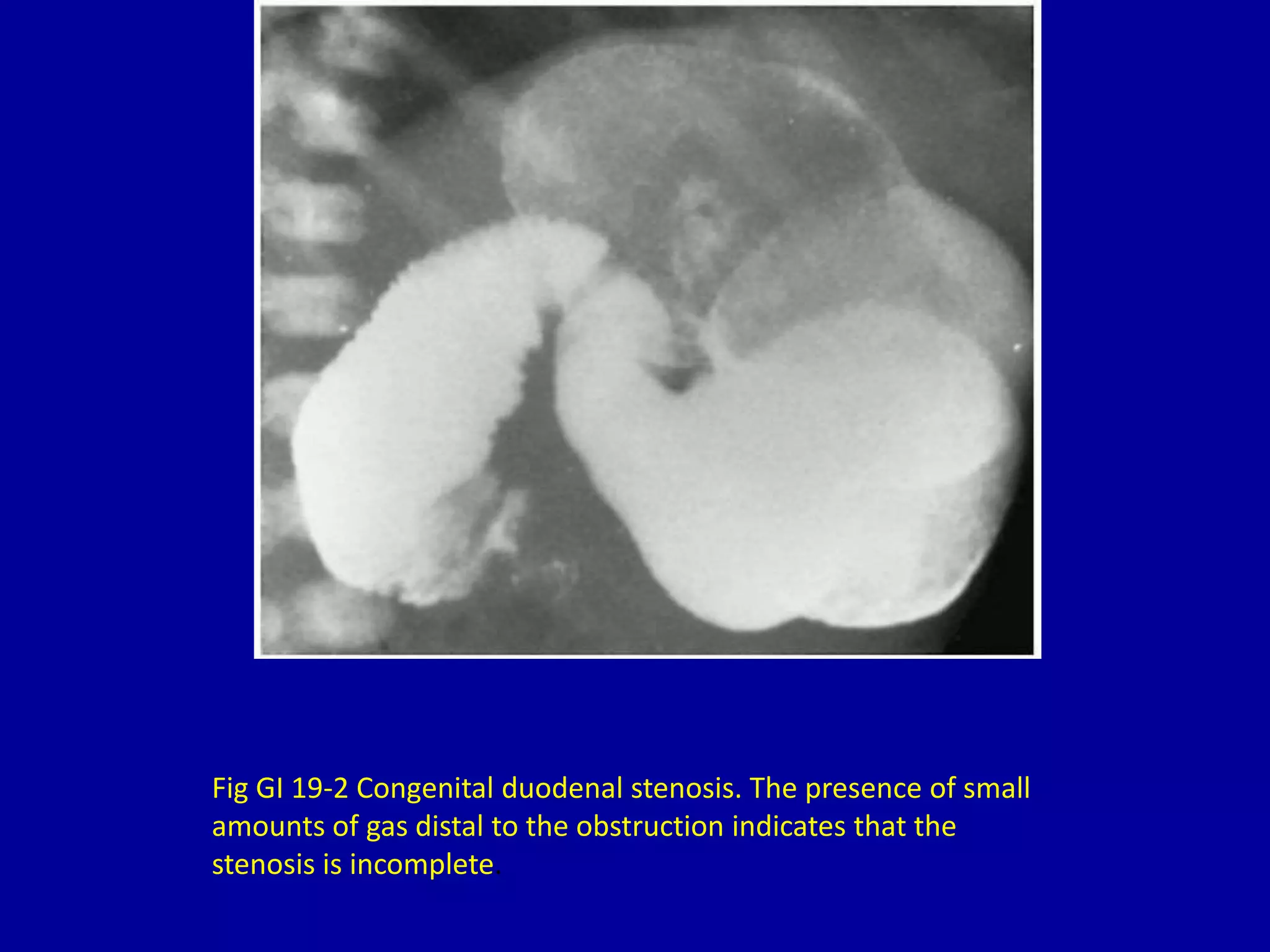 19 duodenal narrowing or obstruction | PPTX