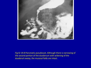 19 duodenal narrowing or obstruction | PPTX