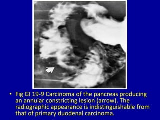 19 duodenal narrowing or obstruction | PPTX