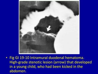 19 duodenal narrowing or obstruction | PPTX