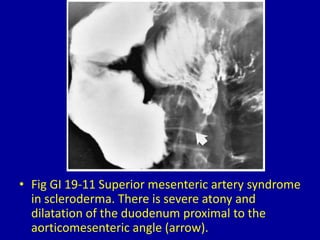 19 duodenal narrowing or obstruction | PPTX