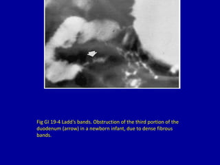 19 duodenal narrowing or obstruction | PPTX