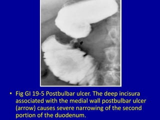 19 duodenal narrowing or obstruction | PPTX