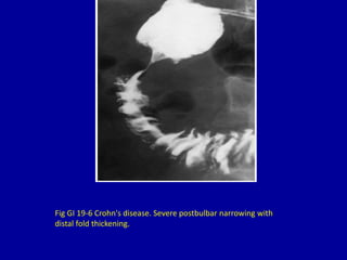 19 duodenal narrowing or obstruction | PPTX