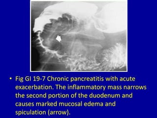 19 duodenal narrowing or obstruction | PPTX