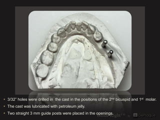 19 fibular graft case | PPT