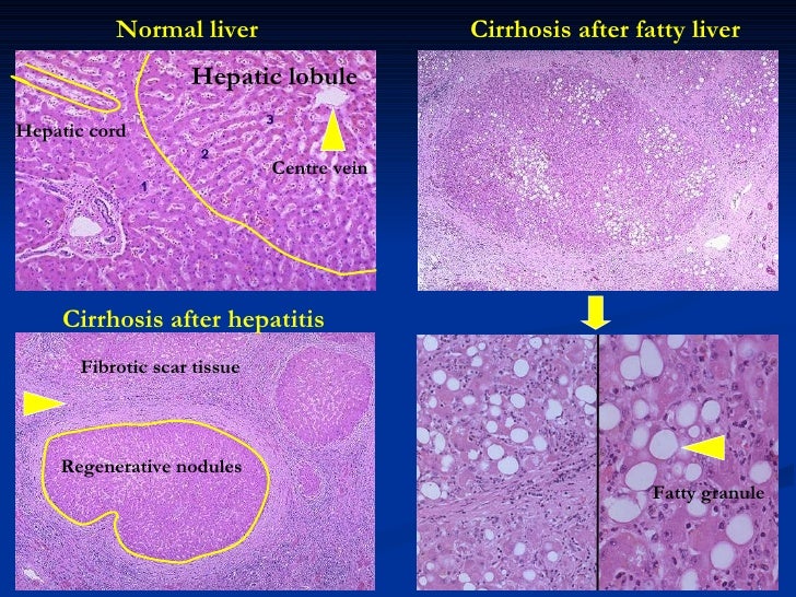 19 hepatic cirrhosis