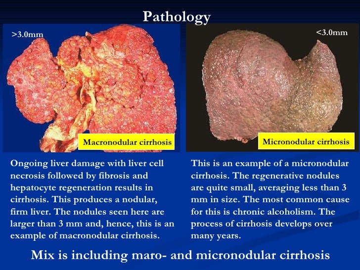 19 hepatic cirrhosis