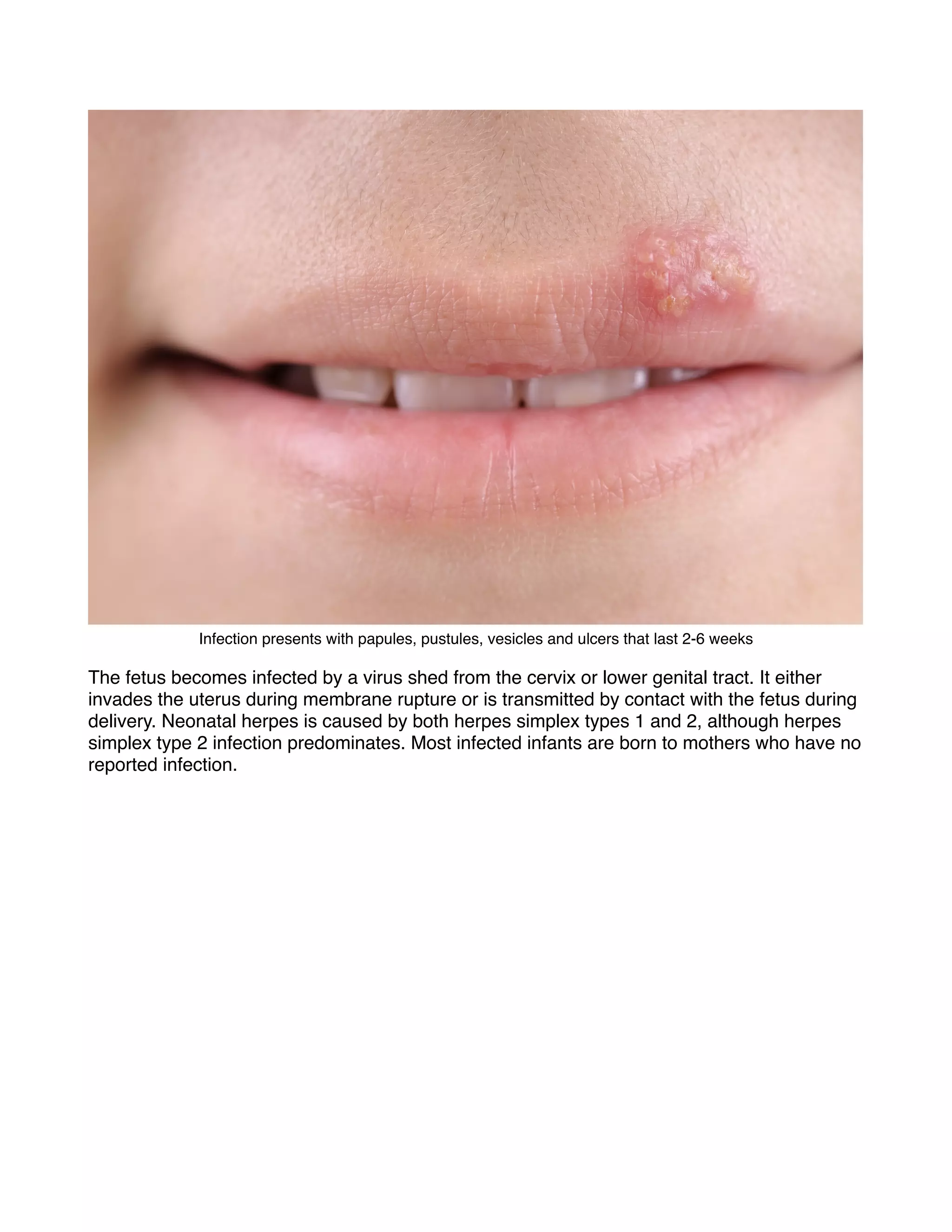 Herpes Virus Infection in Pregnancy | PDF