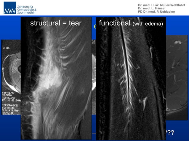 Bryan English - classification of muscle injuries in sport | PDF ...