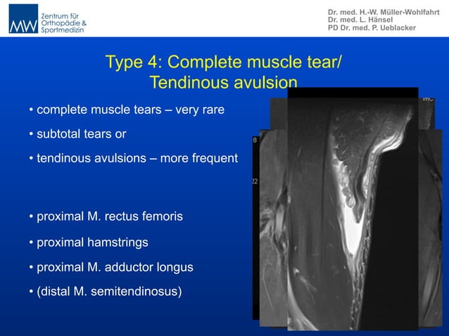 Bryan English - classification of muscle injuries in sport | PDF ...