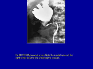 19 obstruction of the ureter | PPTX