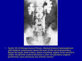 19 obstruction of the ureter | PPT