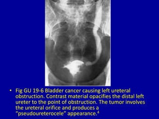 19 obstruction of the ureter | PPTX