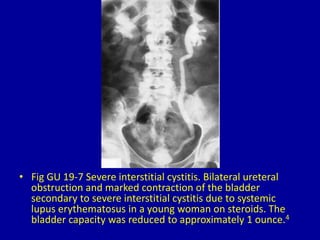 19 obstruction of the ureter | PPTX