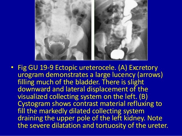 19 obstruction of the ureter