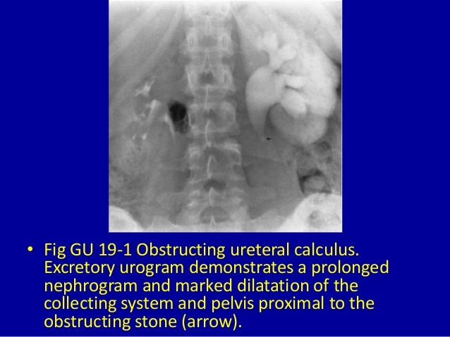 19 obstruction of the ureter