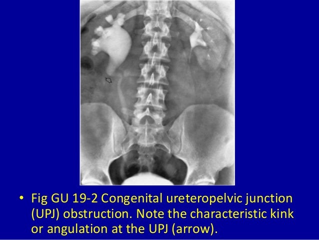 Ureteropelvic Junction Obstruction Humpathcom Human First Aid USMLE