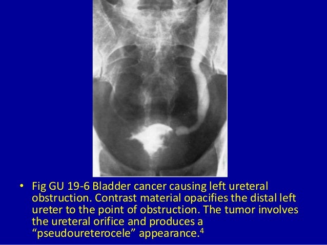 19 obstruction of the ureter